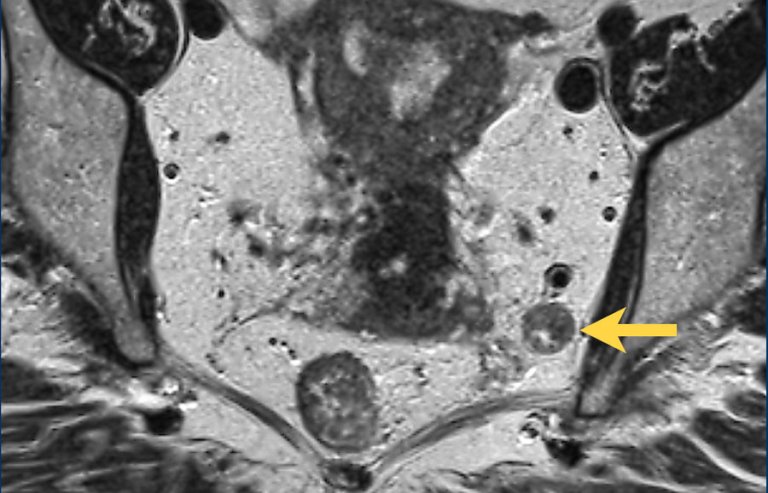 The Radiology Assistant : Rectal Cancer MR staging 3.0