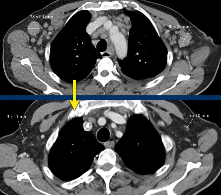 The Radiology Assistant : RECIST 1.1 - and more