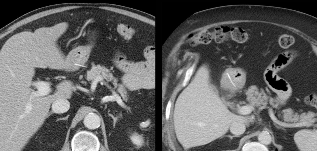The Radiology Assistant : Sharp foreign bodies in GI tract