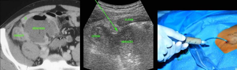 The Radiology Assistant : Appendicitis - US findings