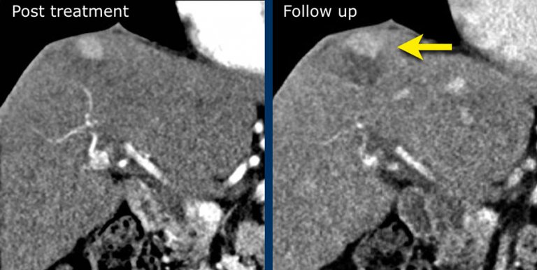 The Radiology Assistant : LI-RADS
