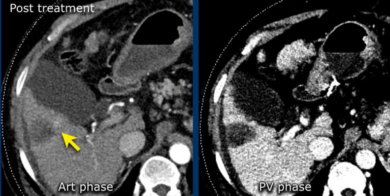 The Radiology Assistant : LI-RADS