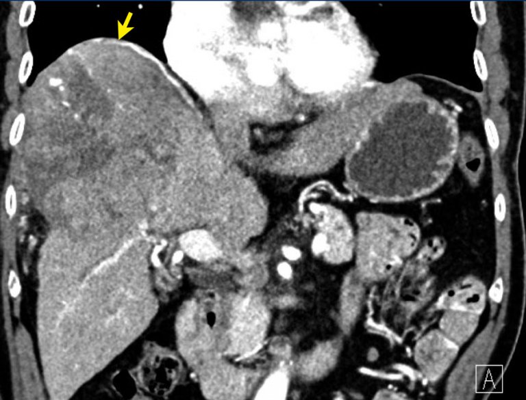 The Radiology Assistant : LI-RADS