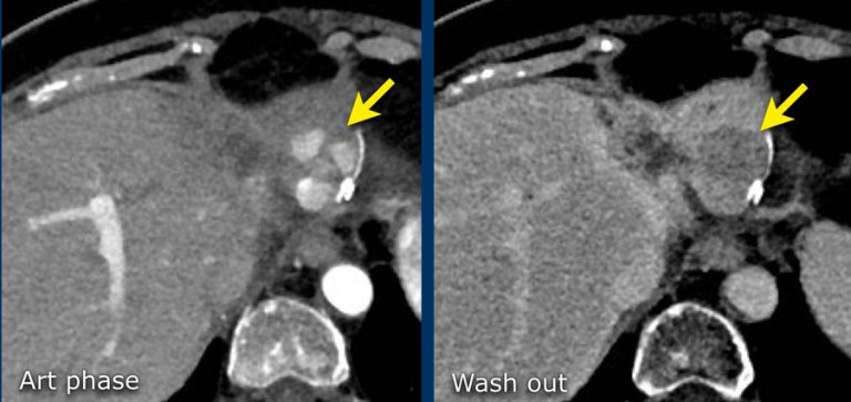 The Radiology Assistant : LI-RADS