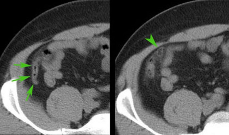 The Radiology Assistant : Appendicitis - Pitfalls in US and CT diagnosis
