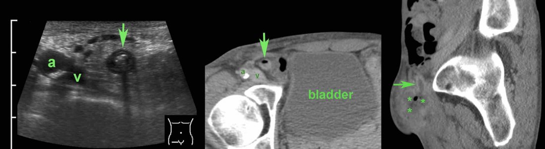 The Radiology Assistant : Appendicitis - Pitfalls in US and CT diagnosis