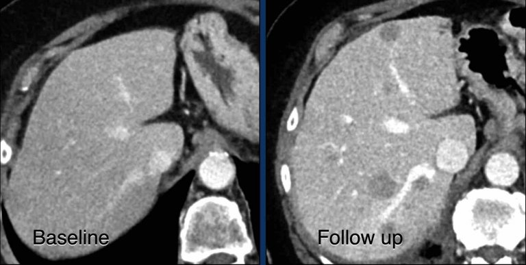The Radiology Assistant : RECIST 1.1 - the basics