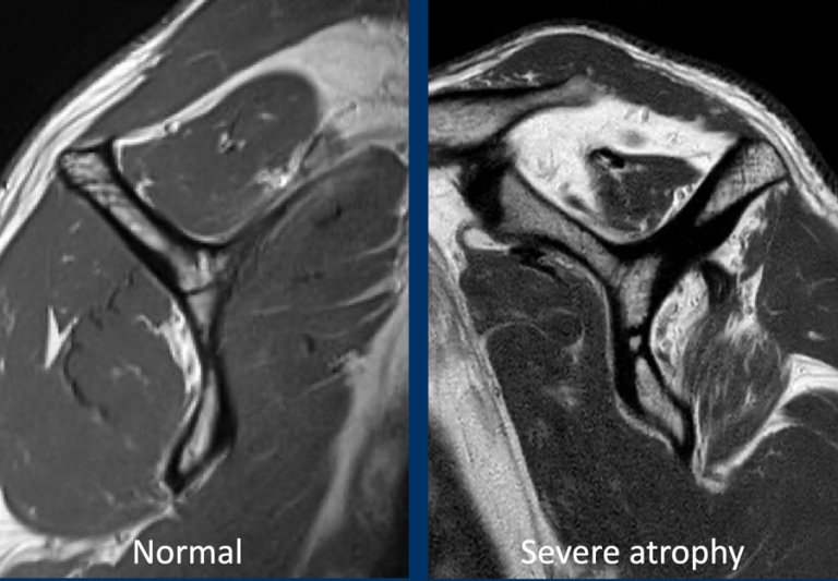 The Radiology Assistant : Shoulder - Rotator cuff injury