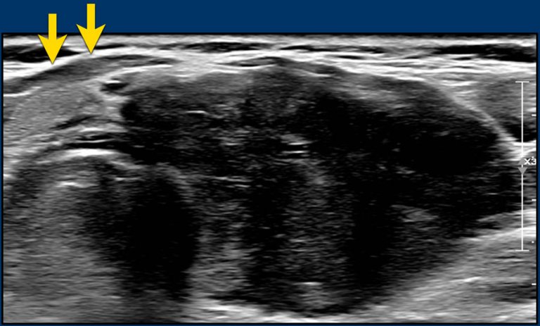 The Radiology Assistant : TI-RADS - Thyroid Imaging Reporting and Data ...