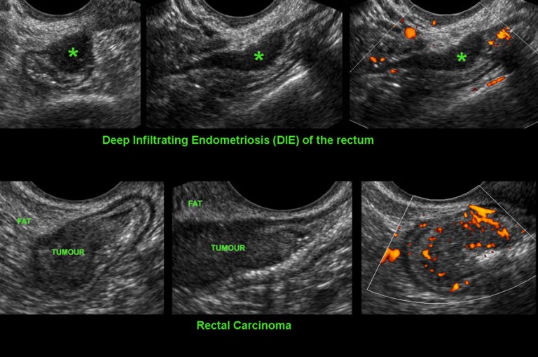 The Radiology Assistant : Transvaginal Ultrasound for Non ...