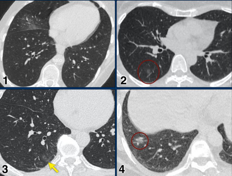 The Radiology Assistant : COVID-19 CO-RADS classification