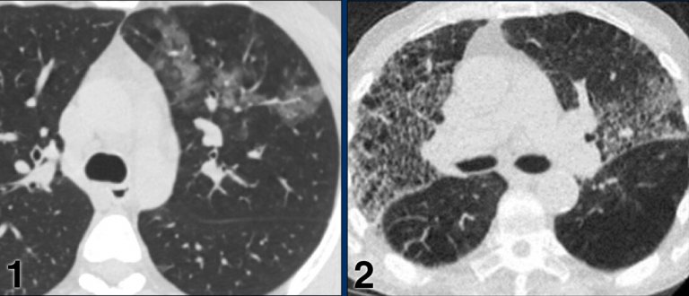 The Radiology Assistant : COVID-19 CO-RADS classification