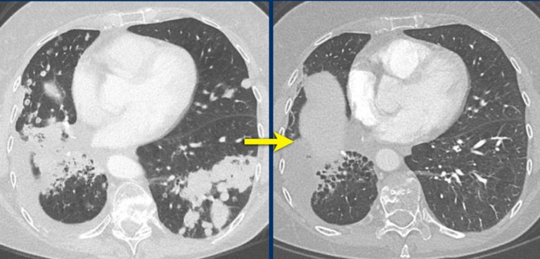 The Radiology Assistant : RECIST 1.1 - examples