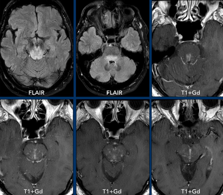 The Radiology Assistant : Enhancement Patterns in CNS disease