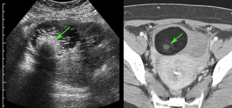 The Radiology Assistant : Acute Abdomen in Gynaecology - Ultrasound