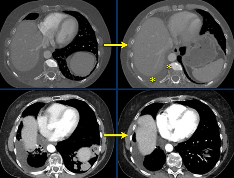 The Radiology Assistant : RECIST 1.1 - examples