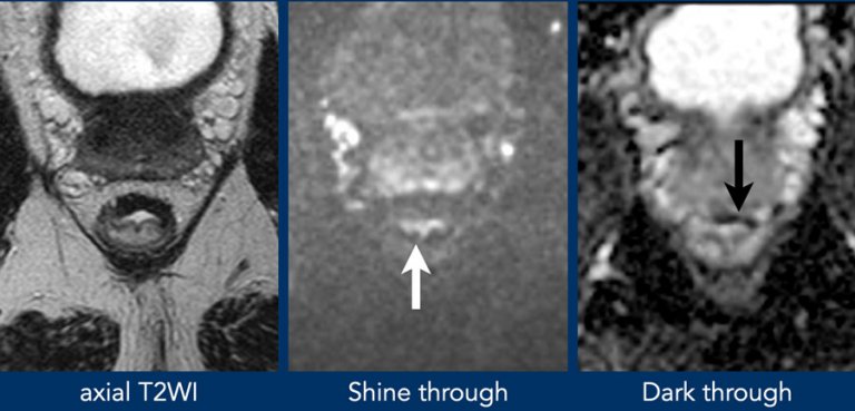 The Radiology Assistant : Rectal Cancer MR staging 3.0