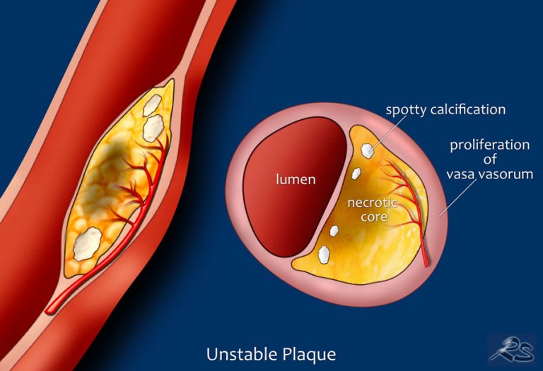 The Radiology Assistant : Coronary Artery Disease-Reporting and Data System