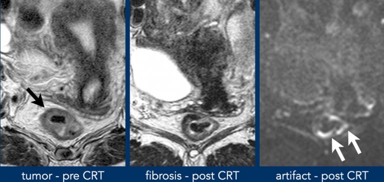 The Radiology Assistant : Rectal Cancer MR staging 3.0