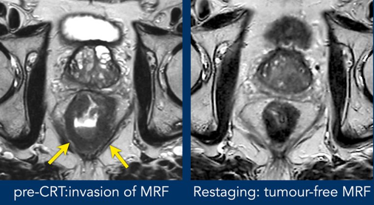The Radiology Assistant : Rectal Cancer MR staging 3.0