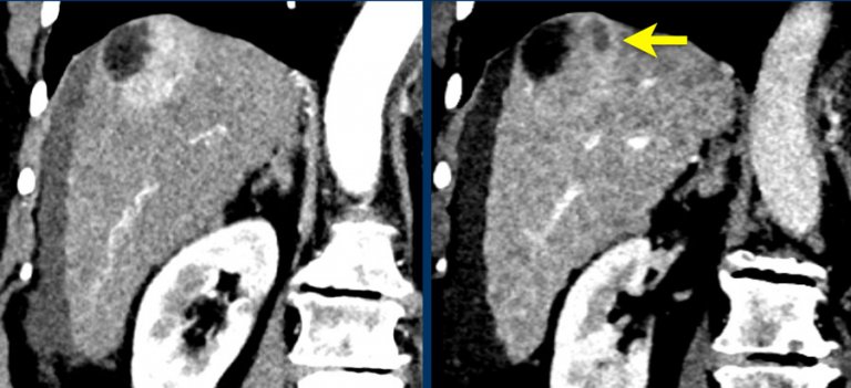 The Radiology Assistant : LI-RADS