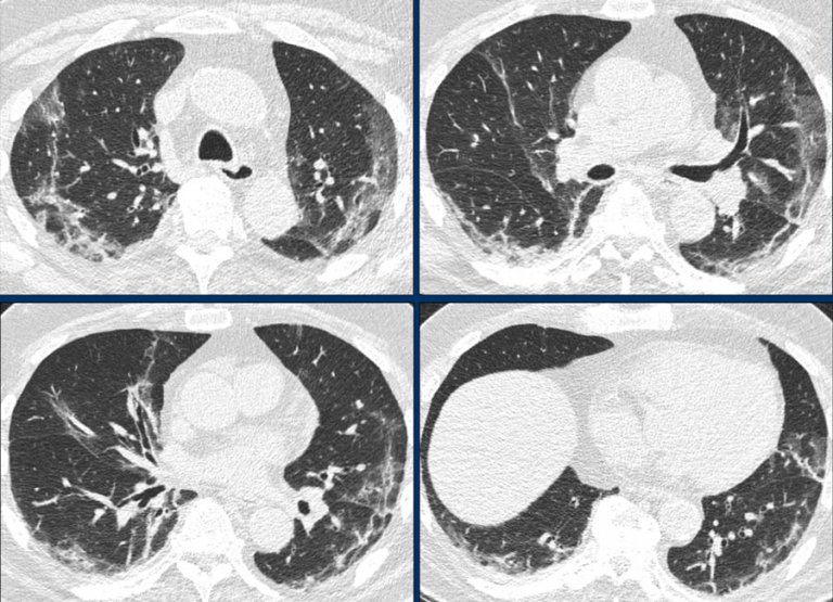 The Radiology Assistant : 32 cases of suspected COVID-19