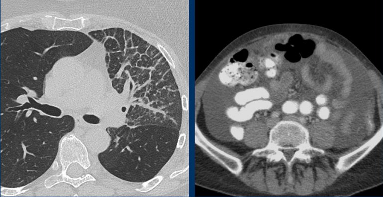 The Radiology Assistant : RECIST 1.1 - and more