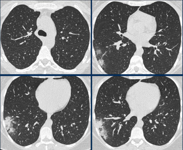 The Radiology Assistant : 32 cases of suspected COVID-19