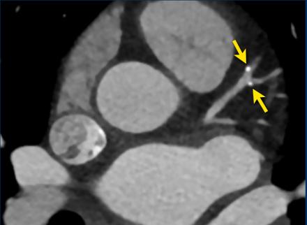 The Radiology Assistant : CAD-RADS