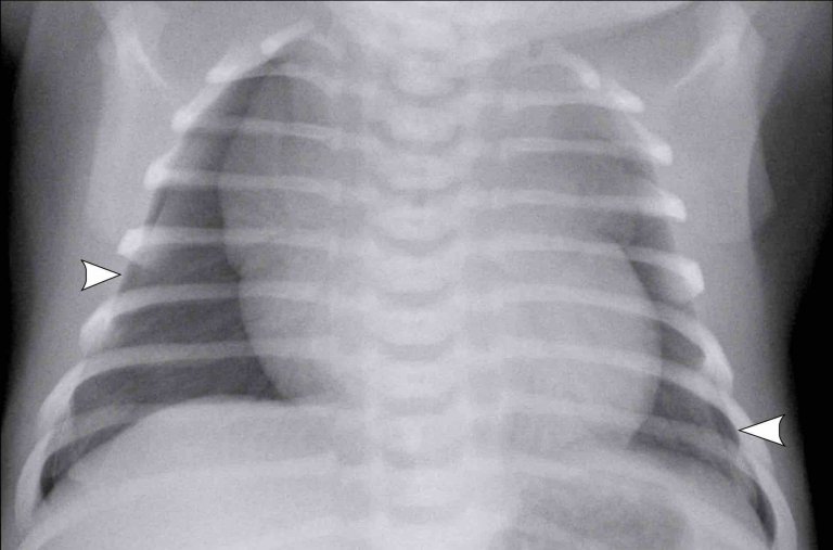The Radiology Assistant : Neonatal Chest