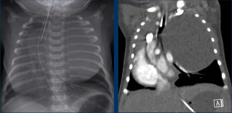 The Radiology Assistant : Neonatal Chest X-Ray