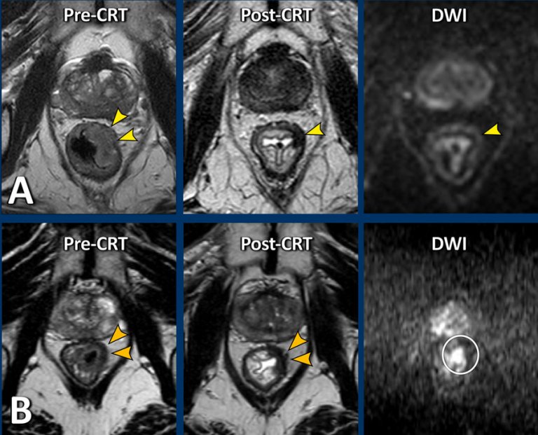 The Radiology Assistant : Rectal Cancer MR staging 3.0