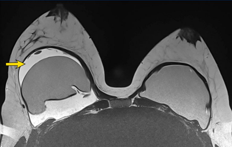 The Radiology Assistant : Breast Implants