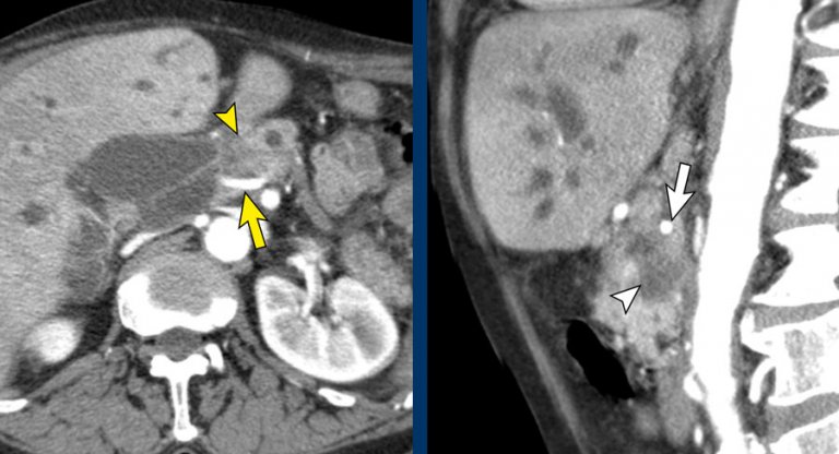 The Radiology Assistant : Pancreatic Cancer - CT staging 2.0