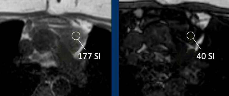 The Radiology Assistant : Thymic masses and mimics