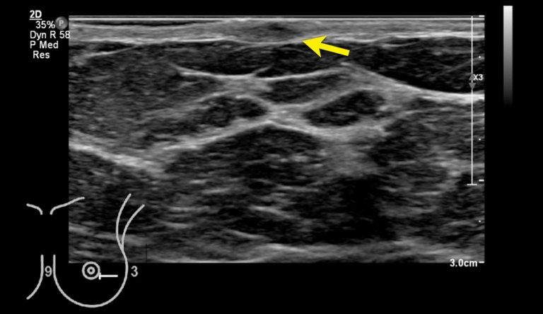 The Radiology Assistant : Ultrasound of the Breast