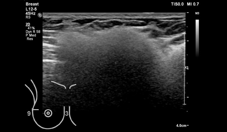 The Radiology Assistant Ultrasound Of The Breast