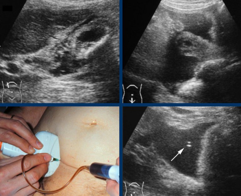 The Radiology Assistant : Gallbladder obstruction