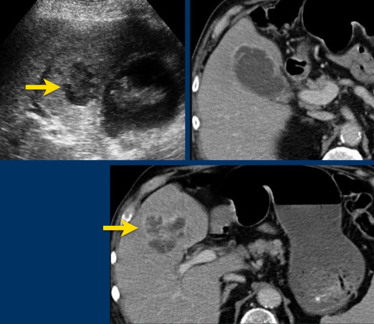 The Radiology Assistant : Gallbladder obstruction