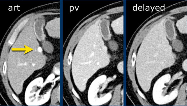 The Radiology Assistant : LI-RADS