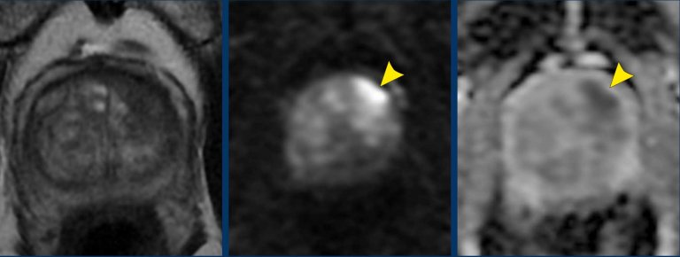 The Radiology Assistant : Prostate Cancer - PI-RADS v2.1