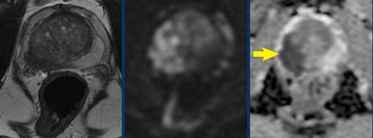 The Radiology Assistant : Prostate Cancer - PI-RADS v2.1