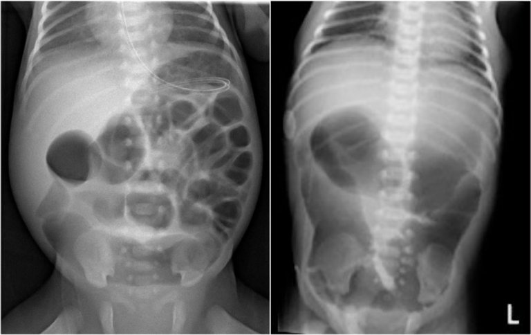 The Radiology Assistant : Acute Abdomen in Neonates