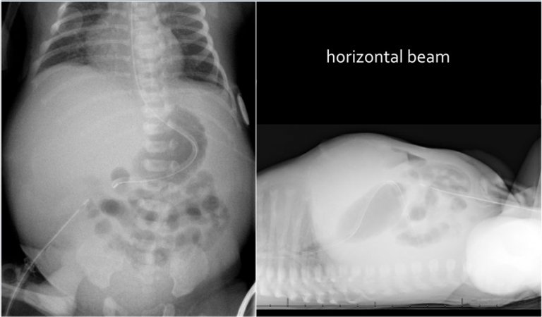 The Radiology Assistant : Acute Abdomen in Neonates