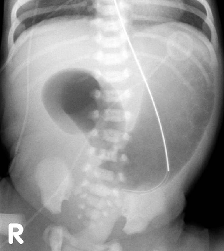 The Radiology Assistant : Acute Abdomen in Neonates