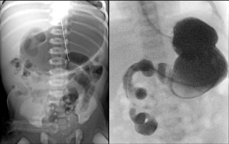 The Radiology Assistant : Acute Abdomen in Neonates