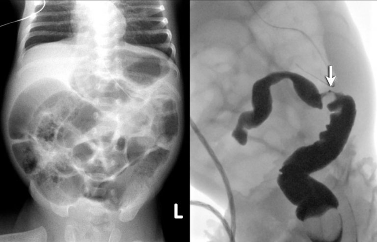 The Radiology Assistant : Acute Abdomen in Neonates