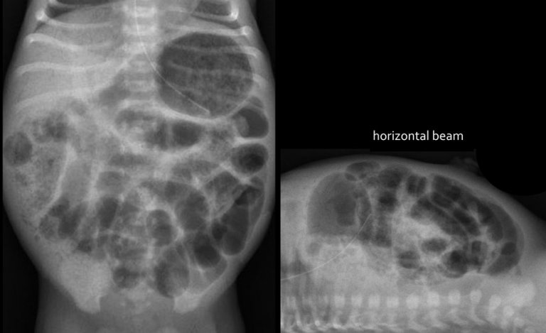 The Radiology Assistant : Acute Abdomen in Neonates