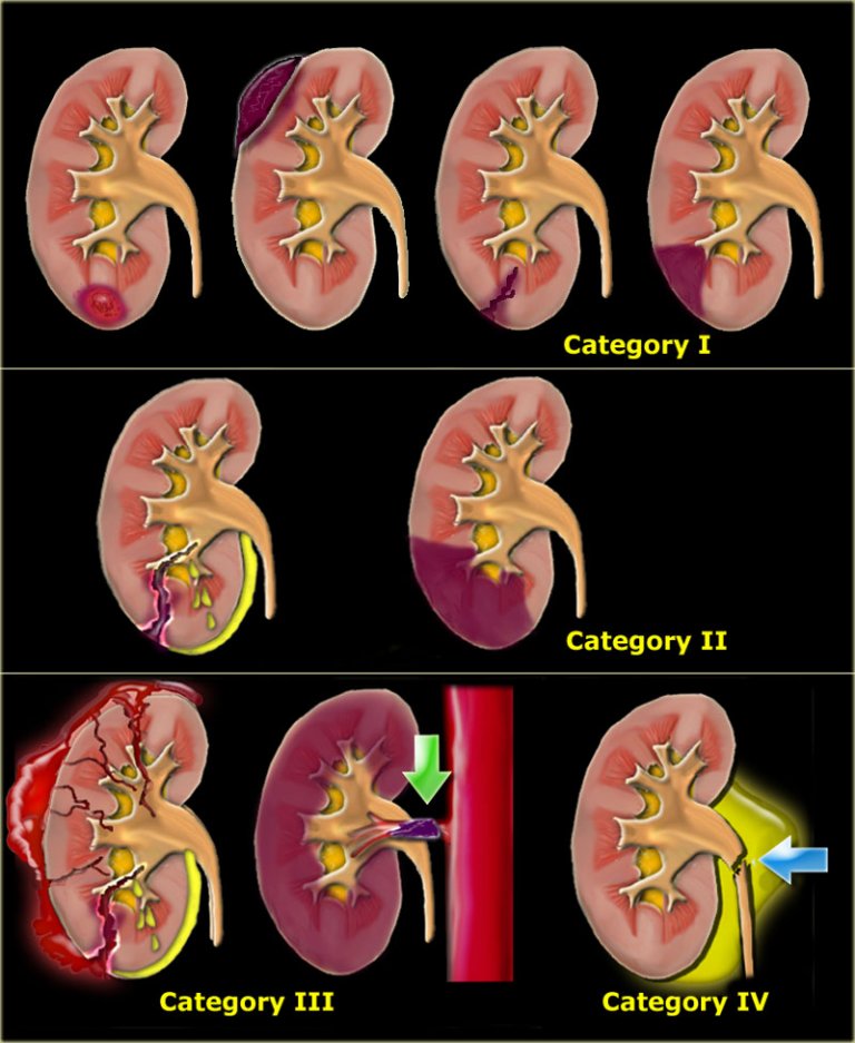The Radiology Assistant : CT in Abdominal Trauma