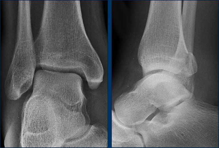 The Radiology Assistant : Foot and Ankle cases